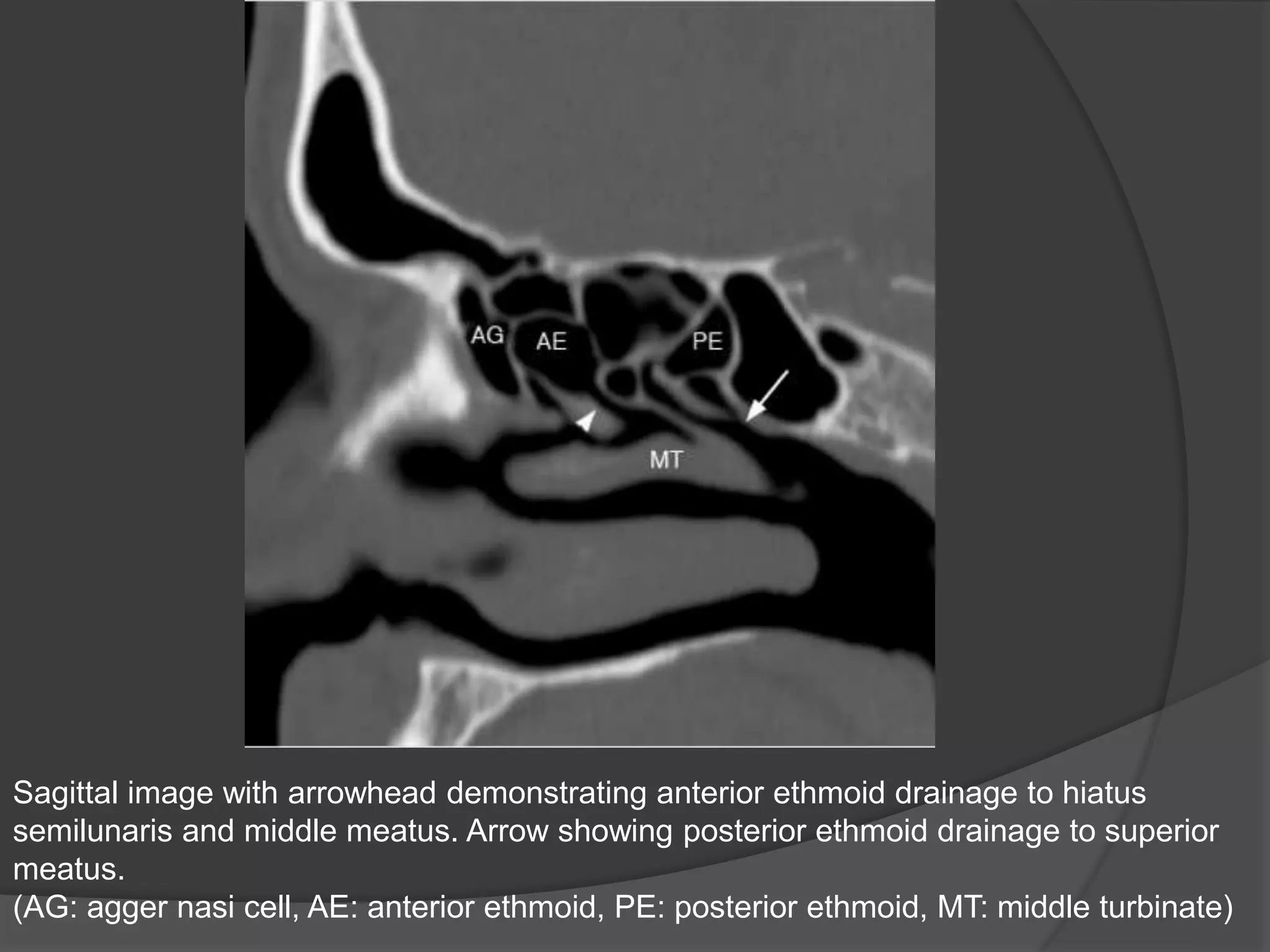 PNS (Para-nasal-sinuses) anatomy and variants | PPTX