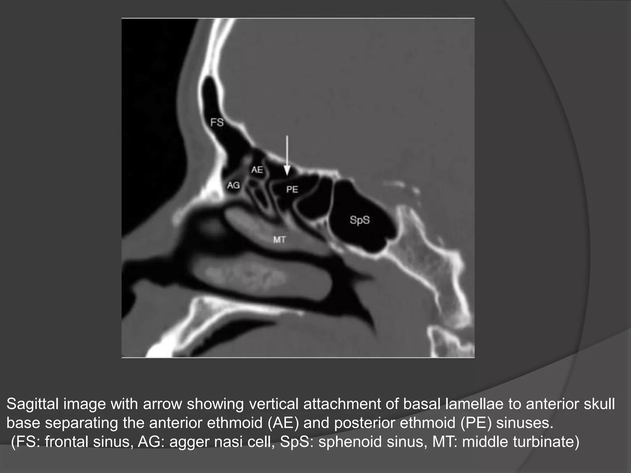 PNS (Para-nasal-sinuses) anatomy and variants | PPTX