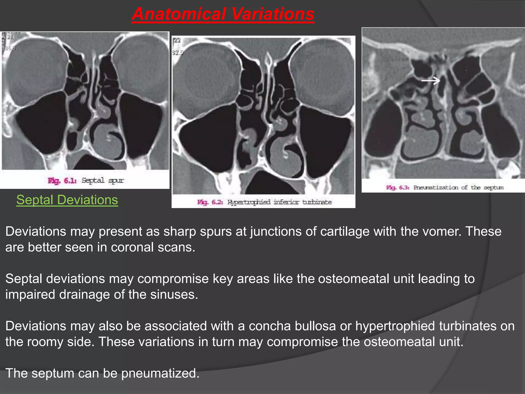 PNS (Para-nasal-sinuses) anatomy and variants | PPTX