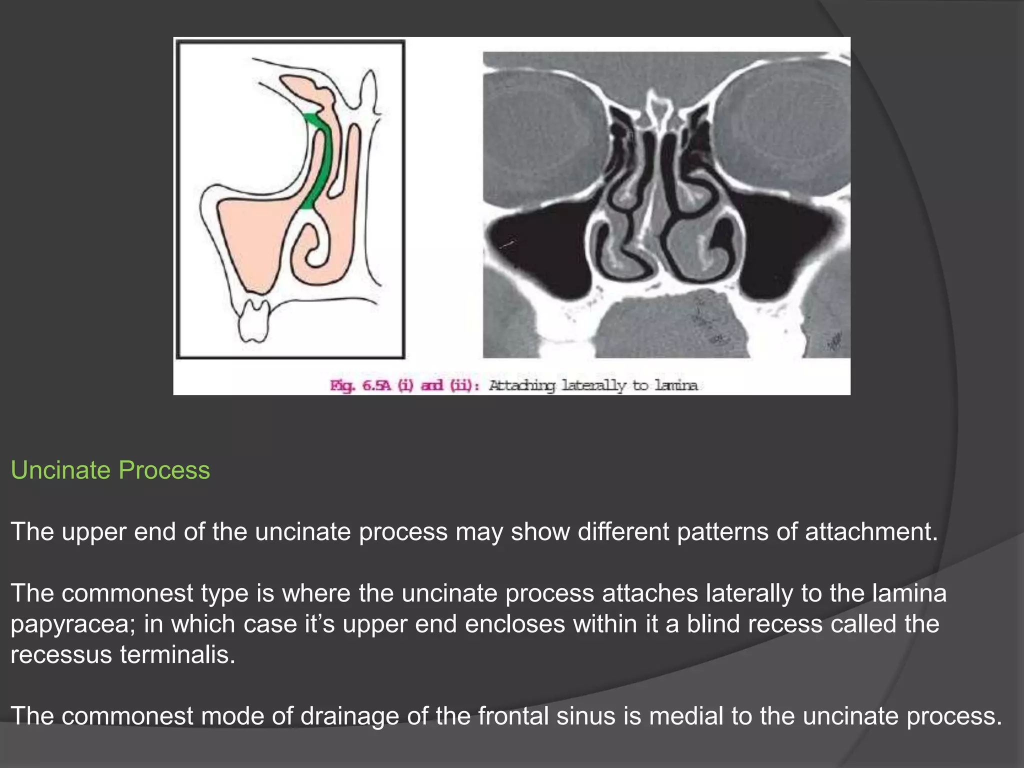 PNS (Para-nasal-sinuses) anatomy and variants | PPTX