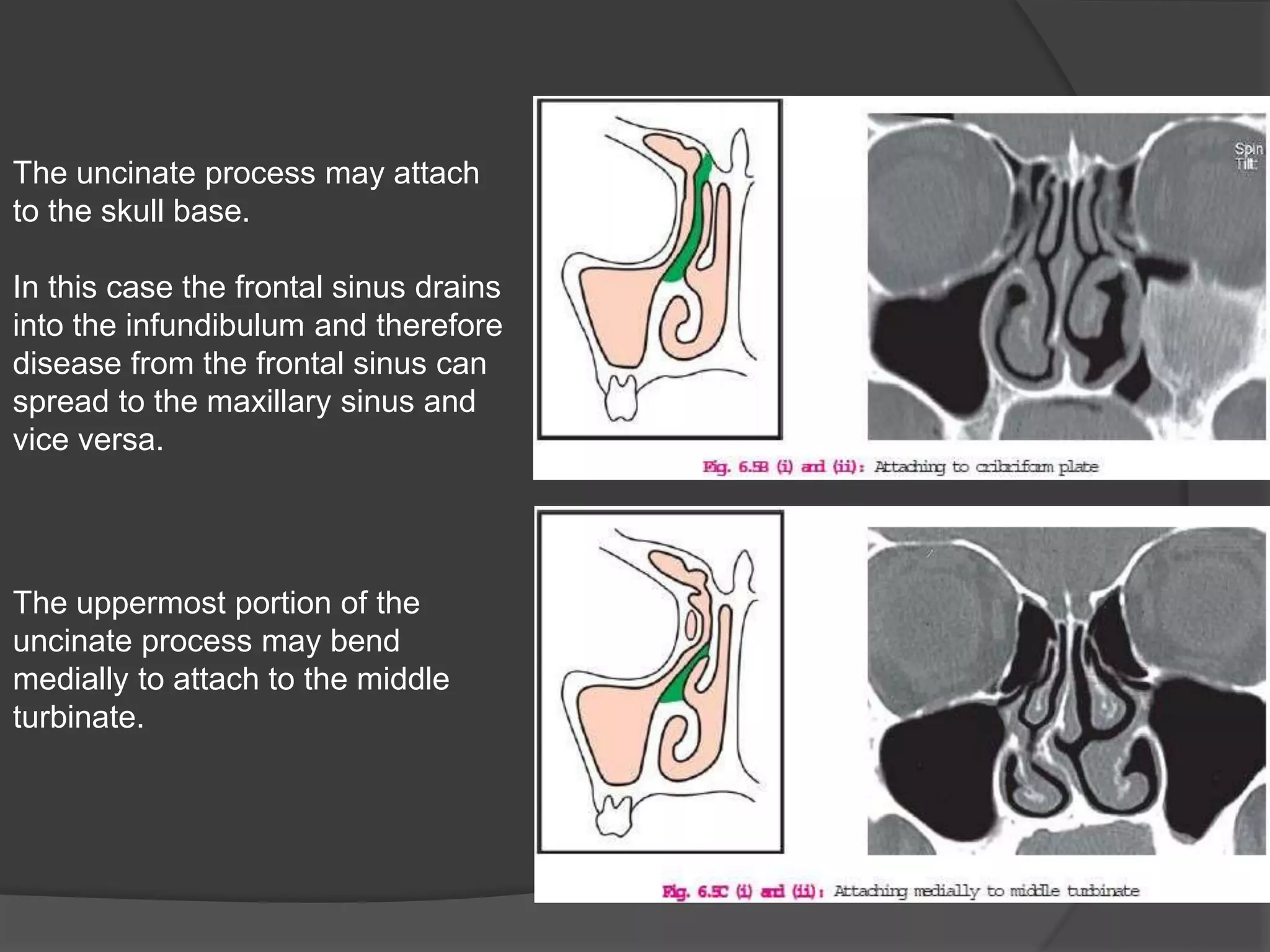 PNS (Para-nasal-sinuses) anatomy and variants | PPTX