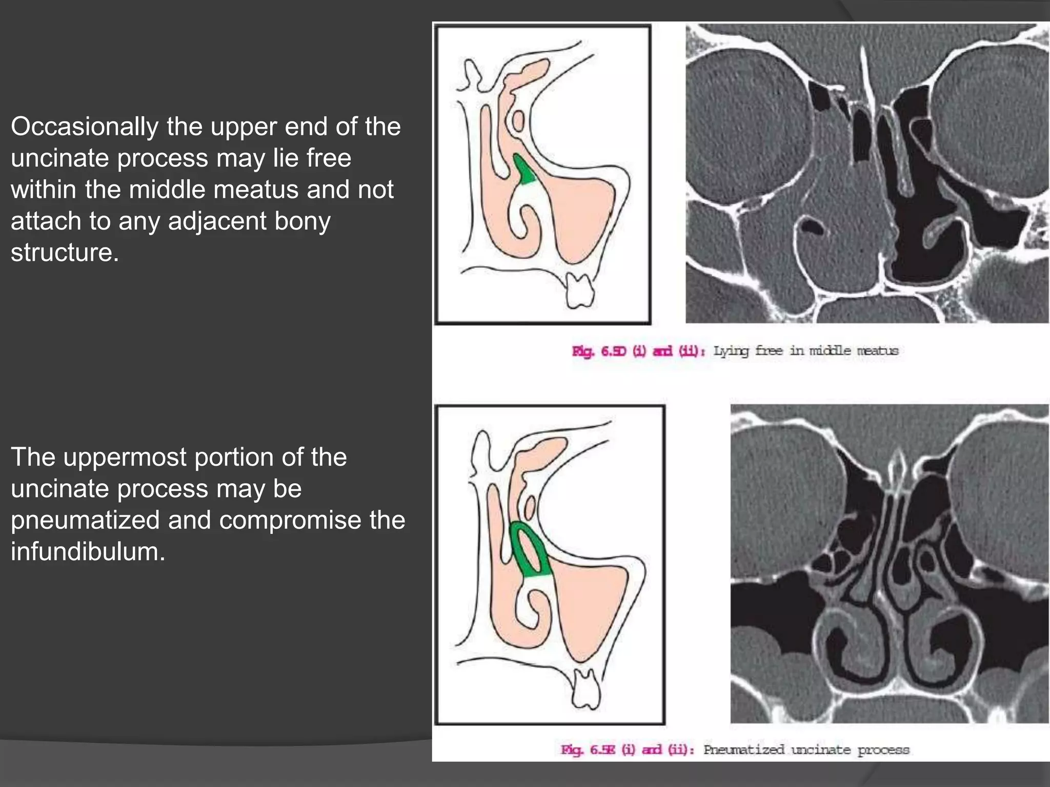 PNS (Para-nasal-sinuses) anatomy and variants | PPTX