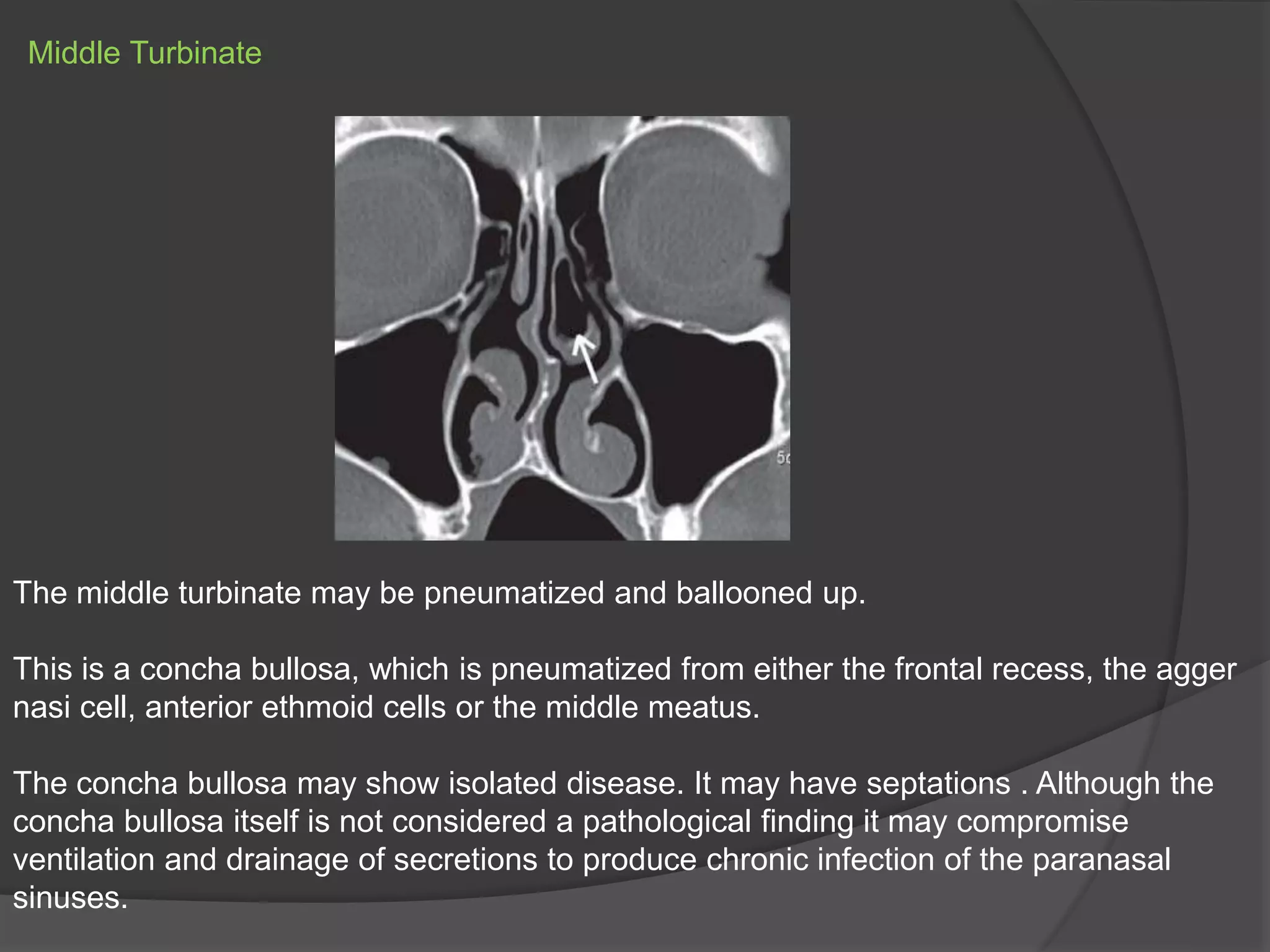PNS (Para-nasal-sinuses) anatomy and variants | PPTX