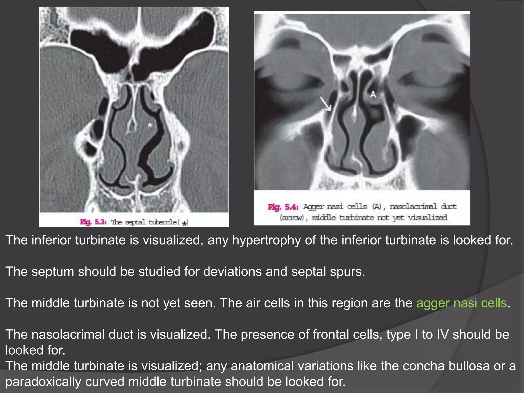 PNS (Para-nasal-sinuses) anatomy and variants | PPTX