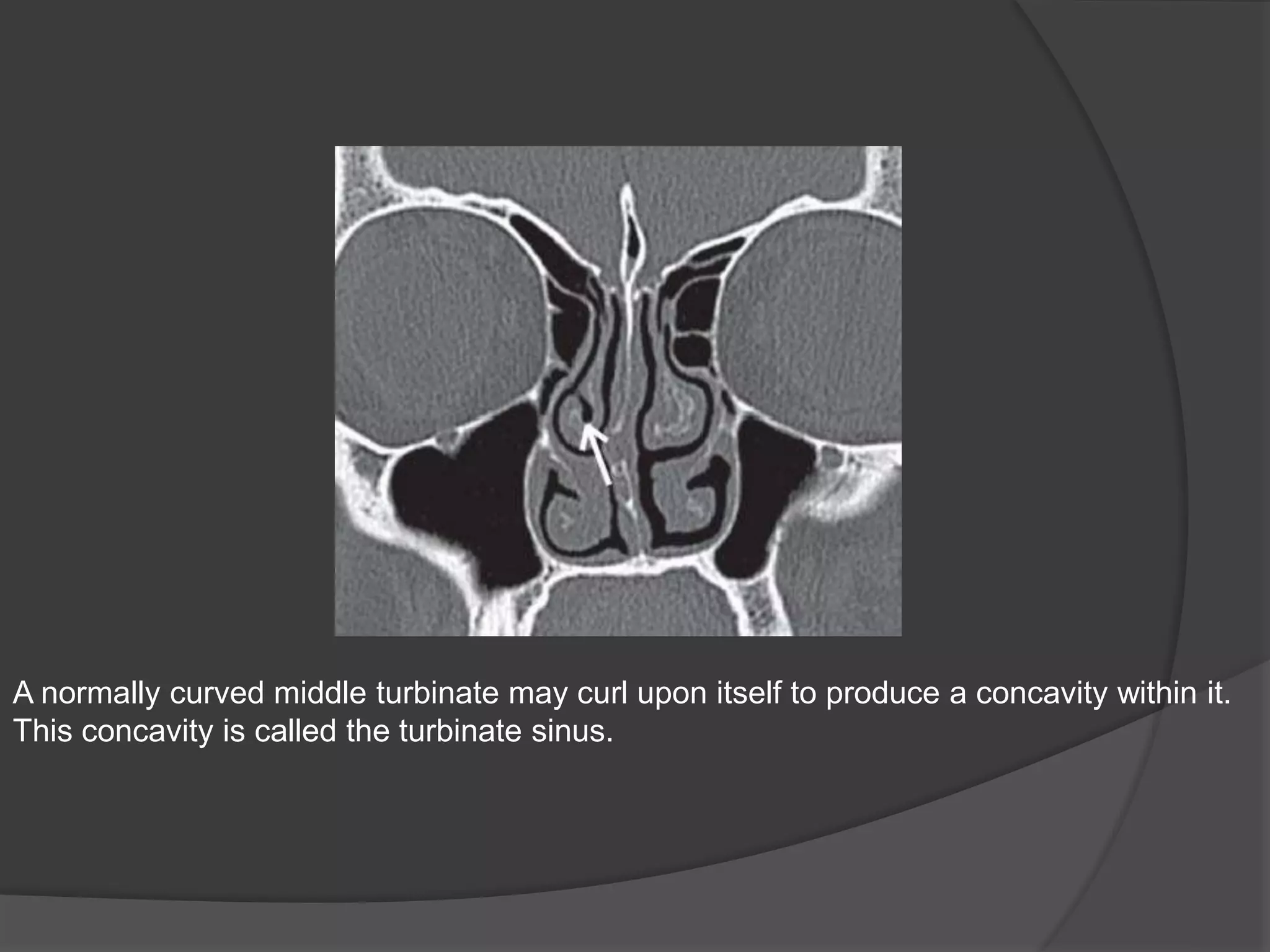 PNS (Para-nasal-sinuses) anatomy and variants | PPTX