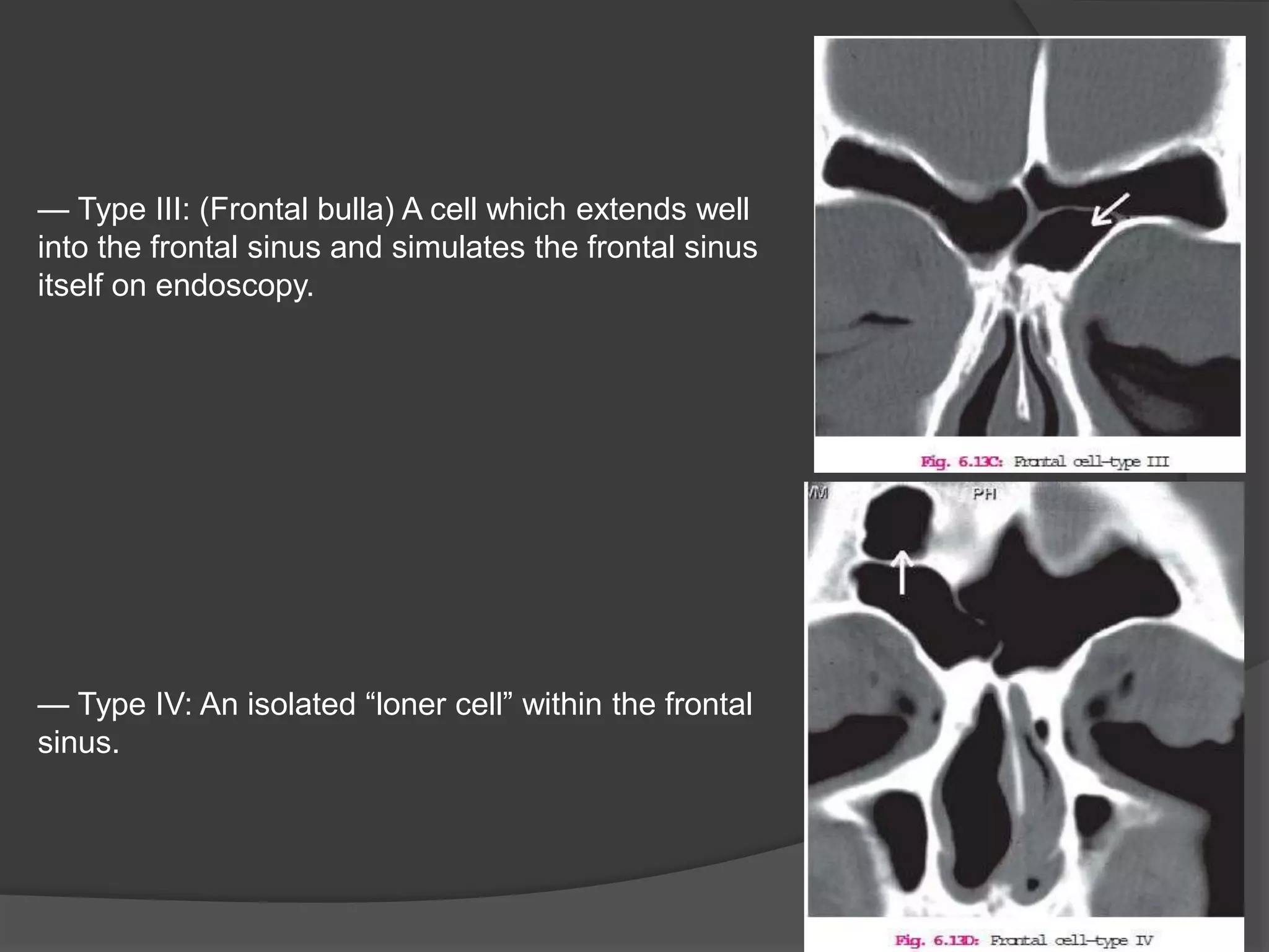 PNS (Para-nasal-sinuses) anatomy and variants | PPTX