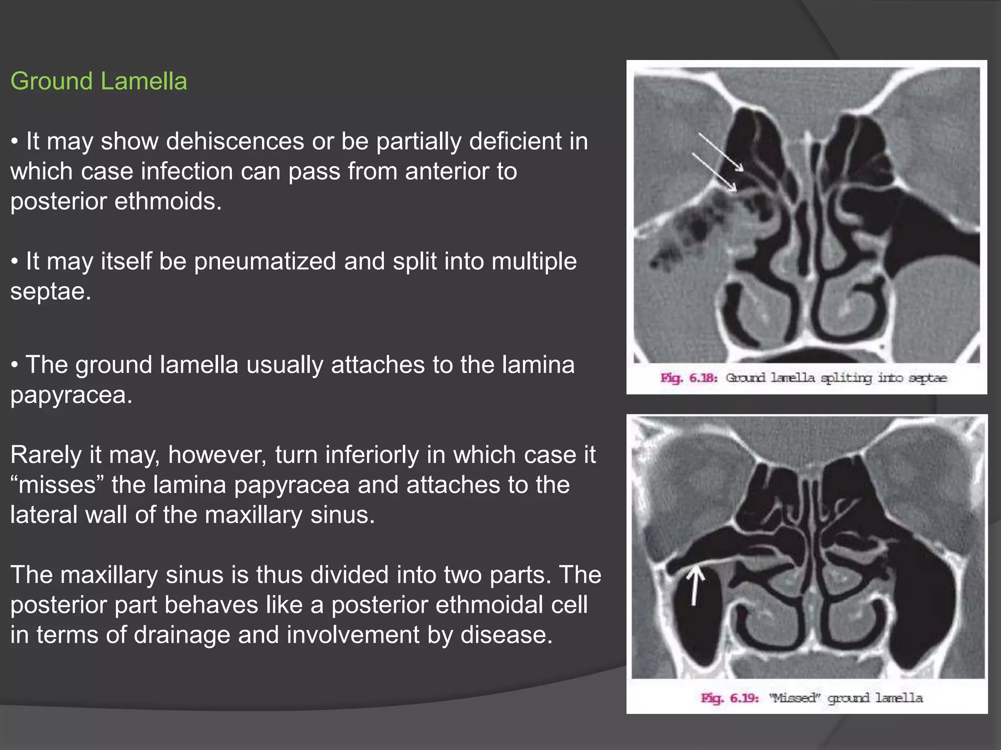 PNS (Para-nasal-sinuses) anatomy and variants | PPTX