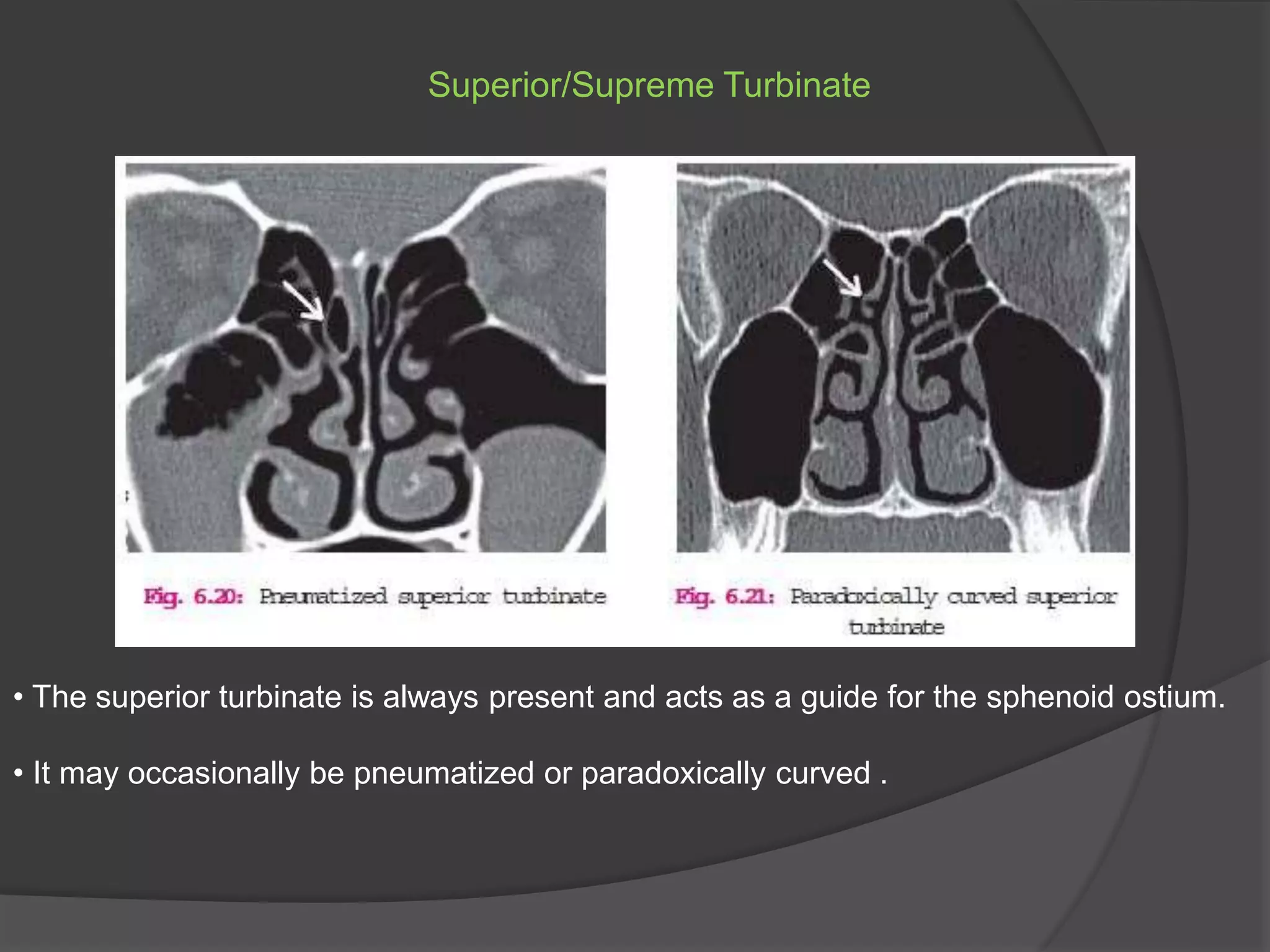 PNS (Para-nasal-sinuses) anatomy and variants | PPTX