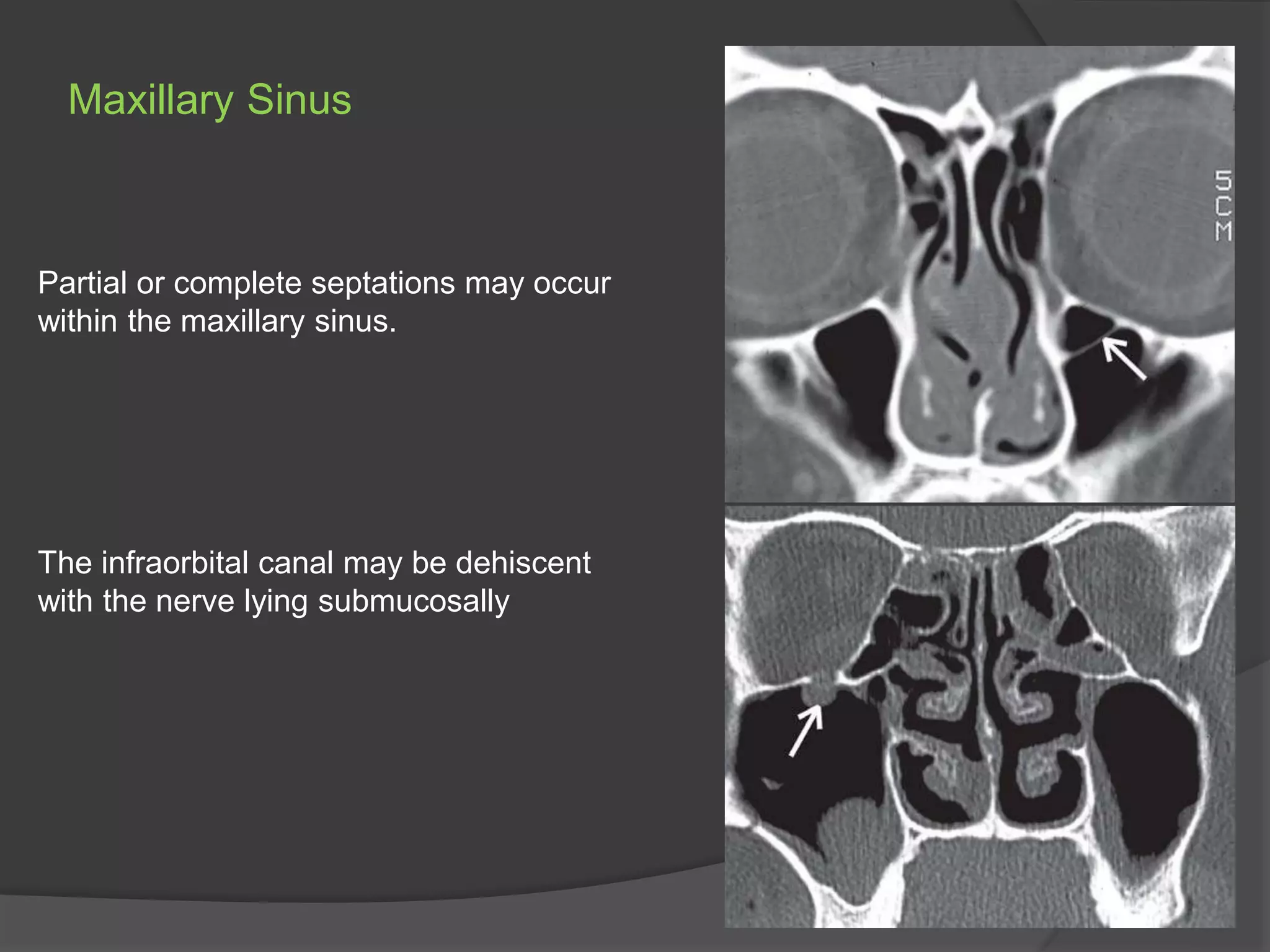 PNS (Para-nasal-sinuses) anatomy and variants | PPTX