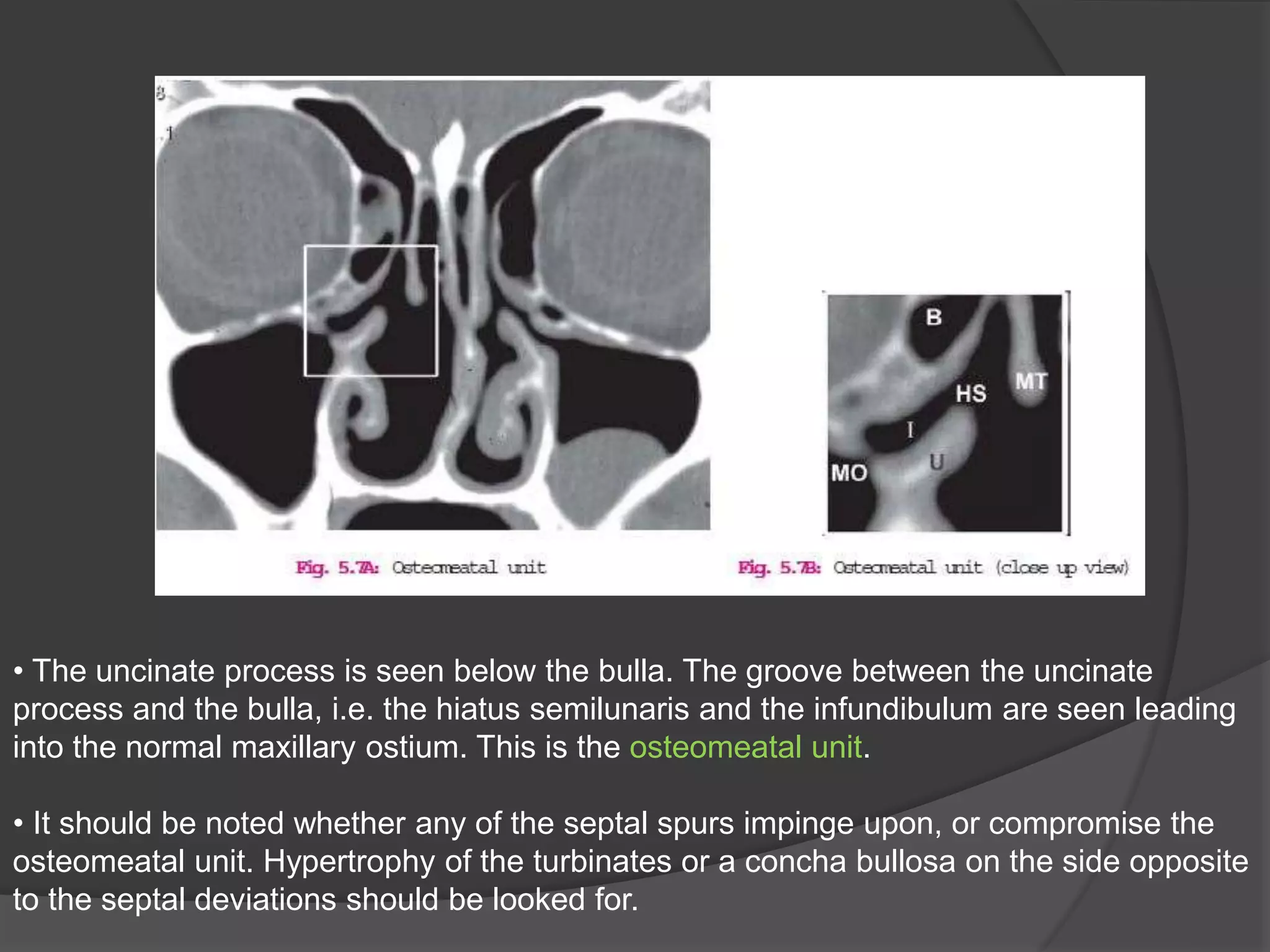 PNS (Para-nasal-sinuses) anatomy and variants | PPTX