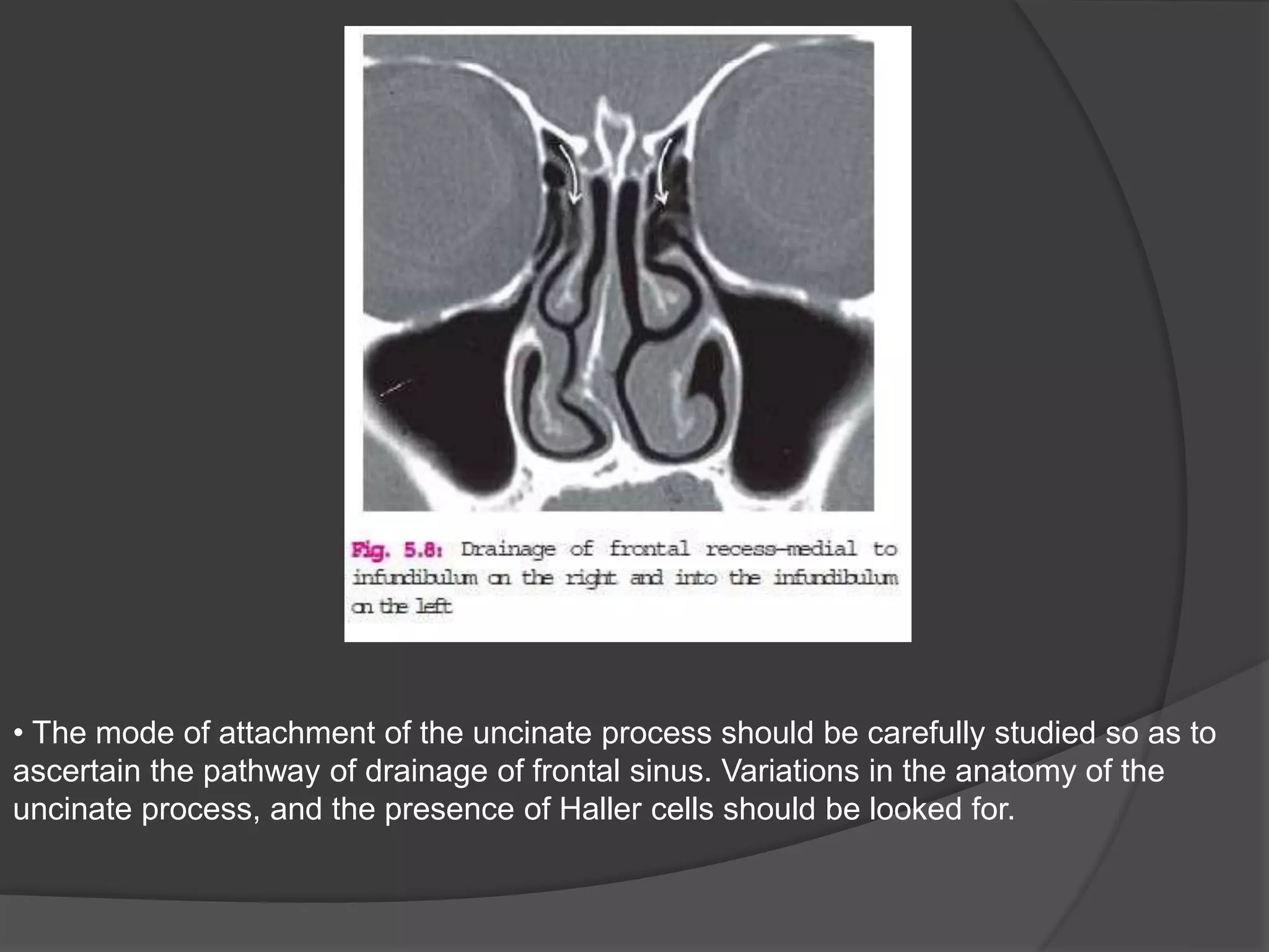 PNS (Para-nasal-sinuses) anatomy and variants | PPTX