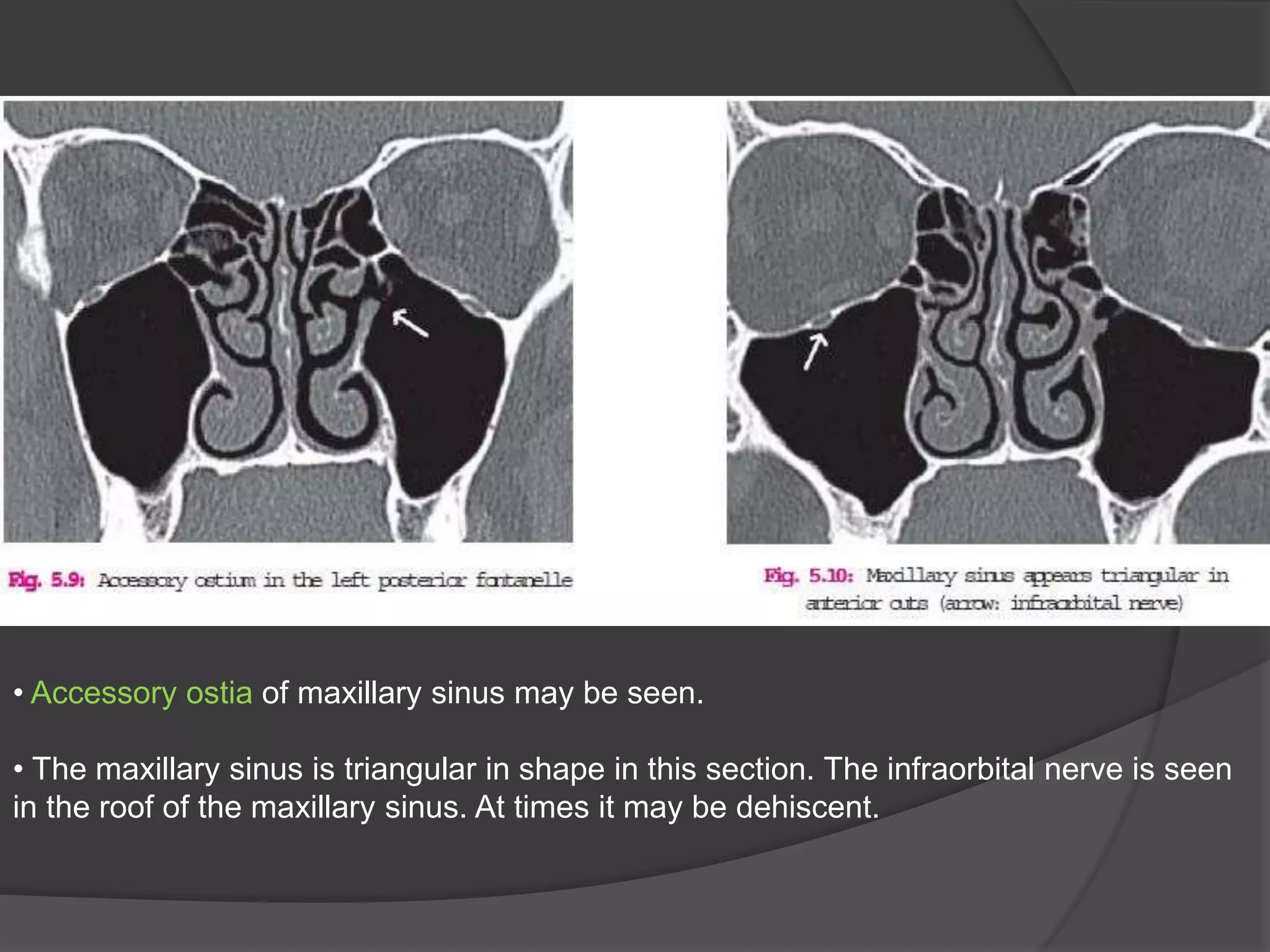 PNS (Para-nasal-sinuses) anatomy and variants | PPTX