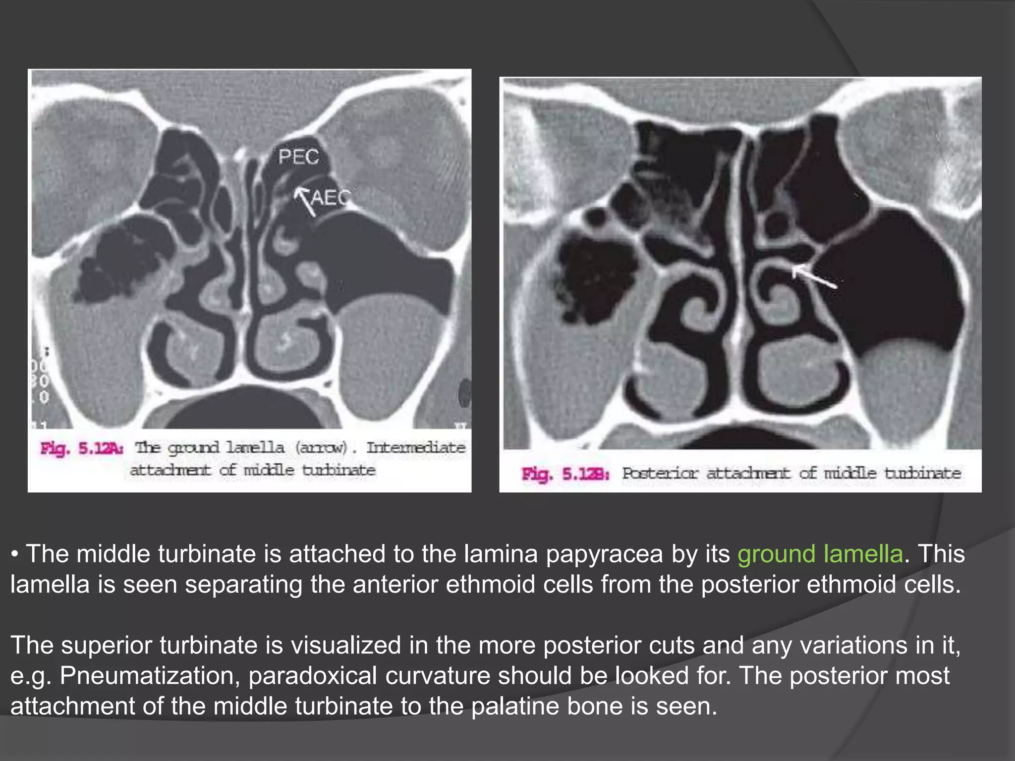 PNS (Para-nasal-sinuses) anatomy and variants | PPTX