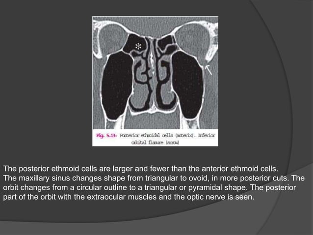 PNS (Para-nasal-sinuses) anatomy and variants | PPTX | Ear, Nose and ...