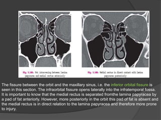 PNS (Para-nasal-sinuses) anatomy and variants | PPTX