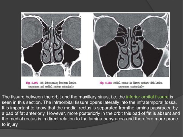 PNS (Para-nasal-sinuses) anatomy and variants | PPTX | Ear, Nose and ...