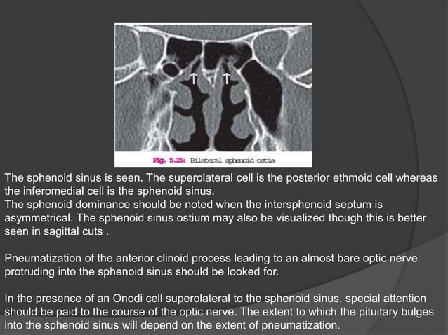 PNS (Para-nasal-sinuses) anatomy and variants | PPTX | Ear, Nose and ...