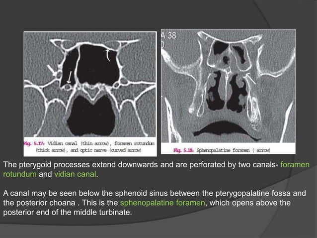 PNS (Para-nasal-sinuses) anatomy and variants | PPTX | Ear, Nose and ...
