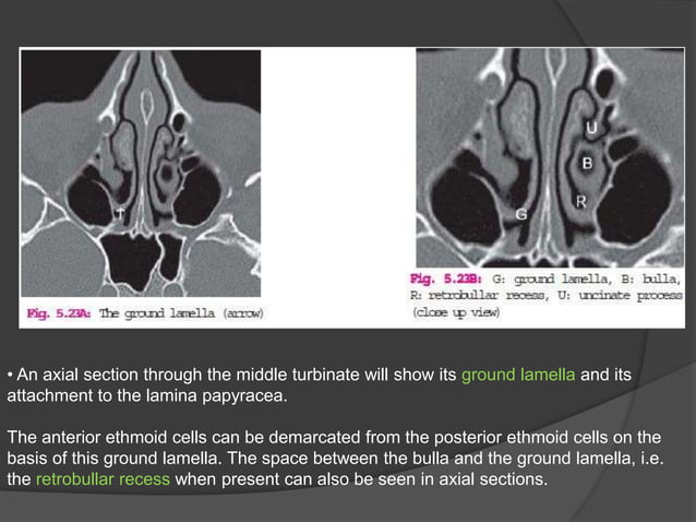 PNS (Para-nasal-sinuses) anatomy and variants | PPTX | Ear, Nose and ...