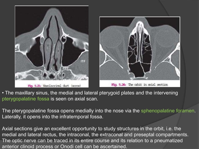 PNS (Para-nasal-sinuses) anatomy and variants | PPTX | Ear, Nose and ...