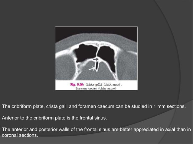 PNS (Para-nasal-sinuses) anatomy and variants | PPTX | Ear, Nose and ...
