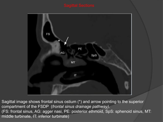 PNS (Para-nasal-sinuses) anatomy and variants | PPTX | Ear, Nose and ...