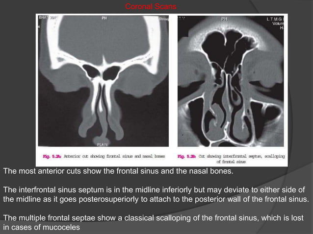 PNS (Para-nasal-sinuses) anatomy and variants | PPTX | Ear, Nose and ...