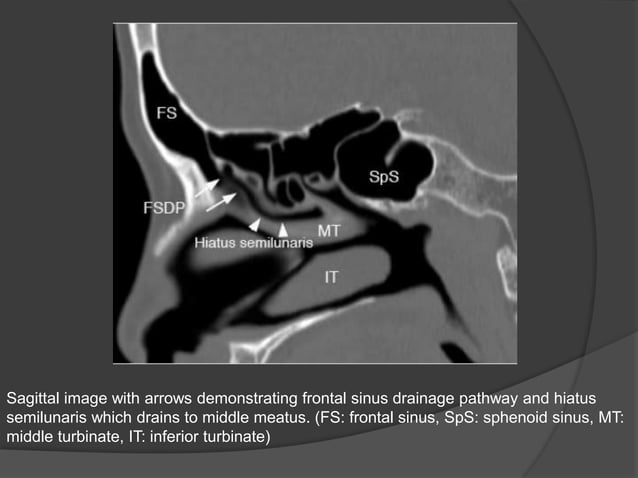 PNS (Para-nasal-sinuses) anatomy and variants | PPTX | Ear, Nose and ...