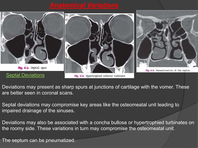 PNS (Para-nasal-sinuses) anatomy and variants | PPTX | Ear, Nose and ...