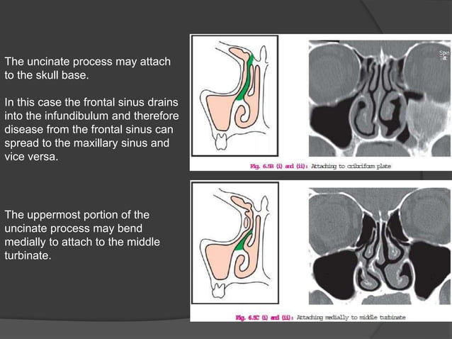 PNS (Para-nasal-sinuses) anatomy and variants | PPTX | Ear, Nose and ...