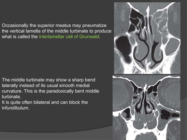 PNS (Para-nasal-sinuses) anatomy and variants | PPTX | Ear, Nose and ...