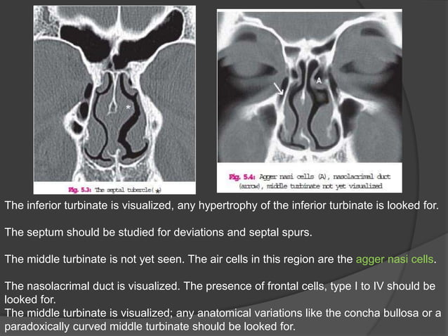 PNS (Para-nasal-sinuses) anatomy and variants | PPTX | Ear, Nose and ...