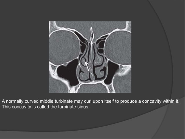PNS (Para-nasal-sinuses) anatomy and variants | PPTX | Ear, Nose and ...