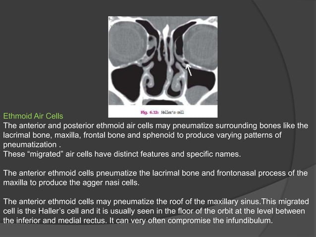 PNS (Para-nasal-sinuses) anatomy and variants | PPTX | Ear, Nose and ...