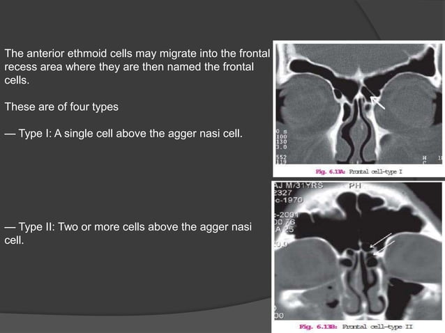 PNS (Para-nasal-sinuses) anatomy and variants | PPTX | Ear, Nose and ...