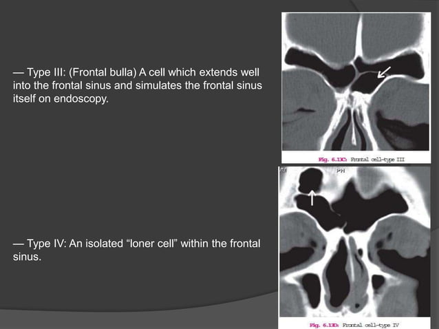 PNS (Para-nasal-sinuses) anatomy and variants | PPTX | Ear, Nose and ...