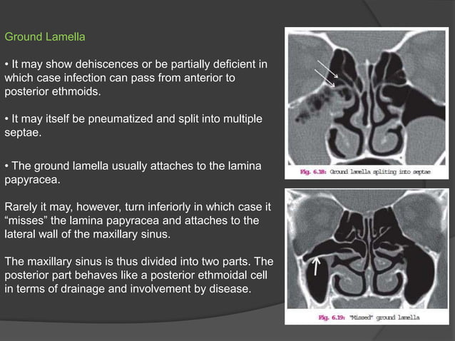 PNS (Para-nasal-sinuses) anatomy and variants | PPTX | Ear, Nose and ...