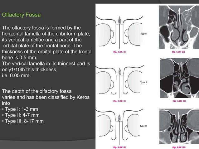 PNS (Para-nasal-sinuses) anatomy and variants | PPTX | Ear, Nose and ...