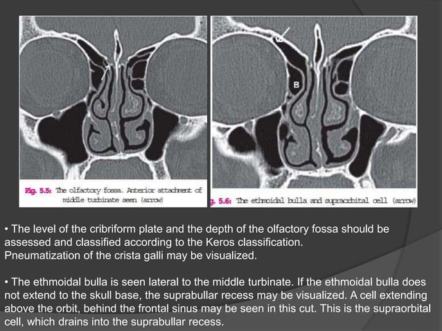 PNS (Para-nasal-sinuses) anatomy and variants | PPTX | Ear, Nose and ...