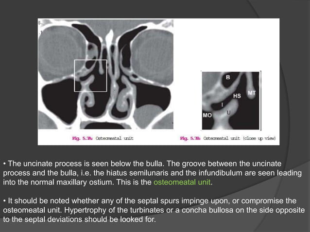 PNS (Para-nasal-sinuses) anatomy and variants | PPTX | Ear, Nose and ...