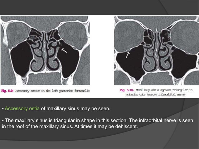 PNS (Para-nasal-sinuses) anatomy and variants | PPTX | Ear, Nose and ...