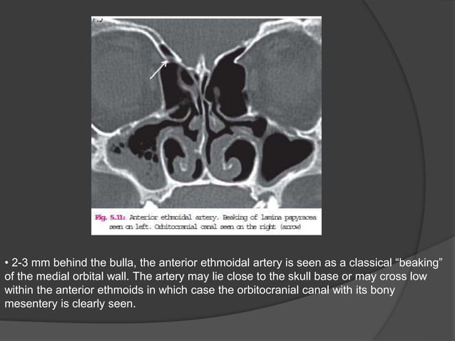 PNS (Para-nasal-sinuses) anatomy and variants | PPTX | Ear, Nose and ...