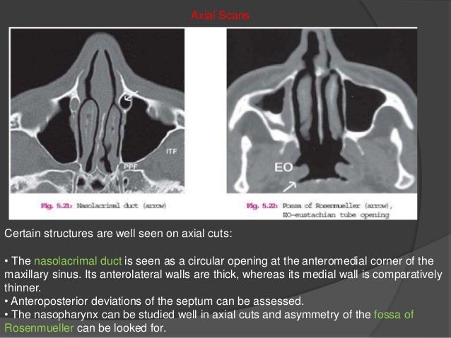 PNS (Para-nasal-sinuses) anatomy and variants
