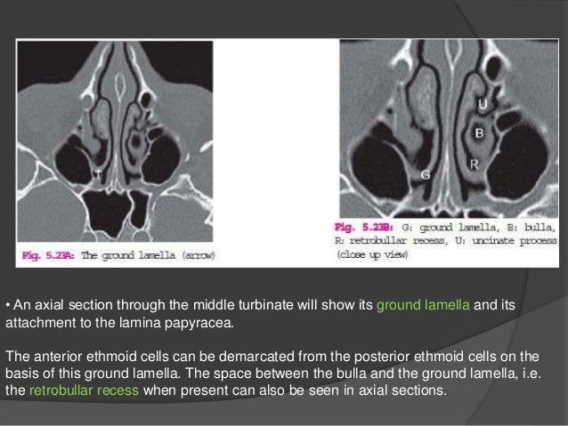 PNS (Para-nasal-sinuses) anatomy and variants