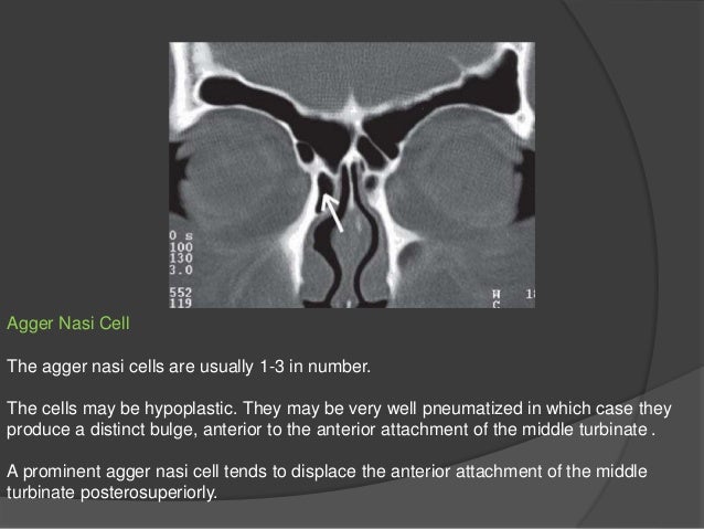 PNS (Para-nasal-sinuses) anatomy and variants