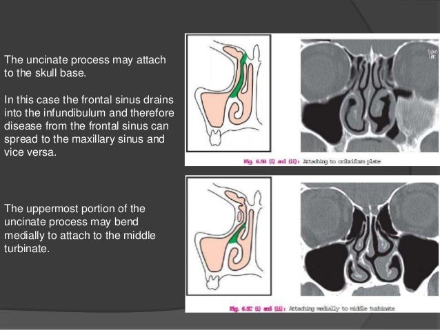 PNS (Para-nasal-sinuses) anatomy and variants