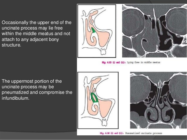 PNS (Para-nasal-sinuses) anatomy and variants