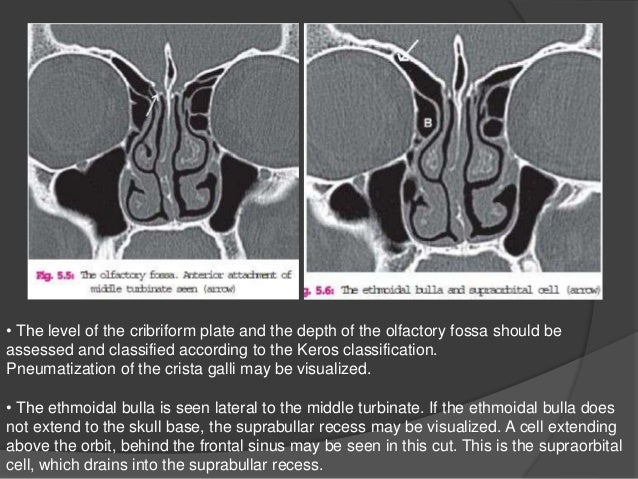 PNS (Para-nasal-sinuses) anatomy and variants