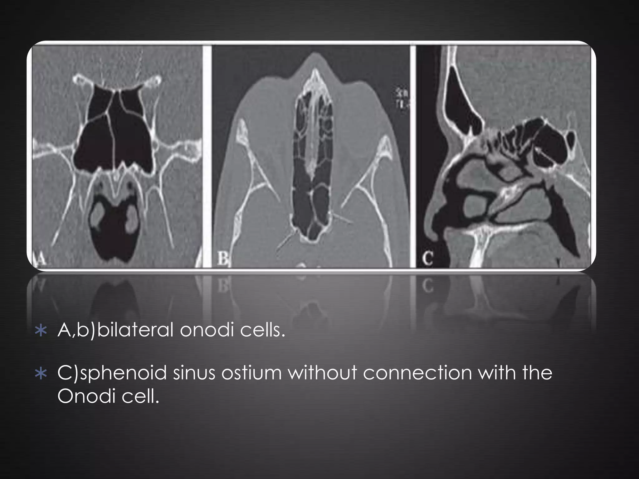 ANATOMICAL VARIANTS OF CT PNS | PPTX