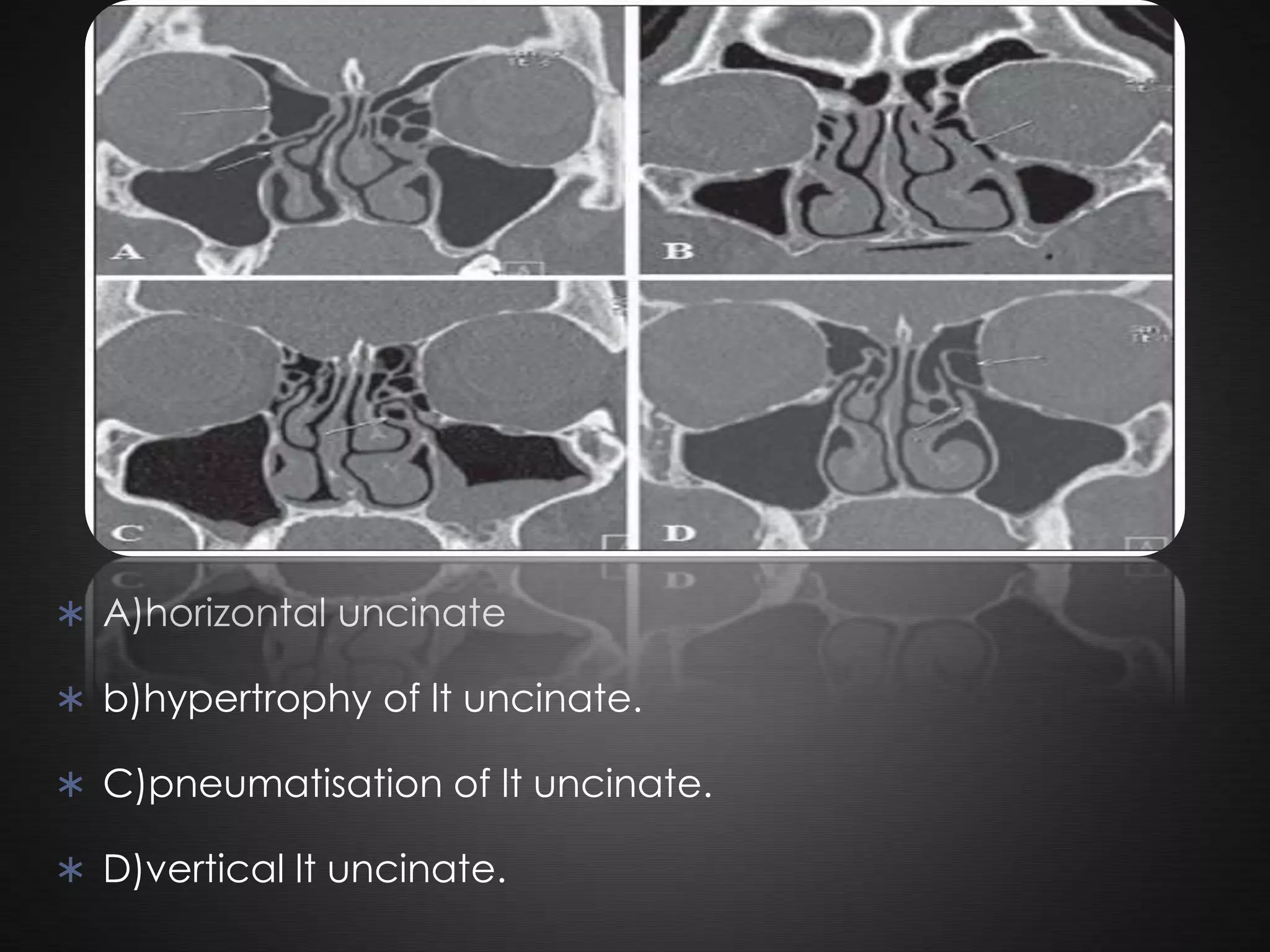 ANATOMICAL VARIANTS OF CT PNS | PPTX